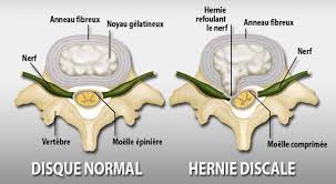 Infiltration pour hernie discale : en quoi cela consiste